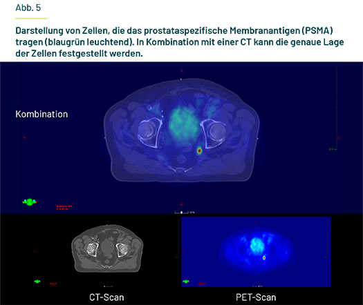 Bildgebung beim metastasierten Prostatakrebs | leben-mit-prostatakrebs.de