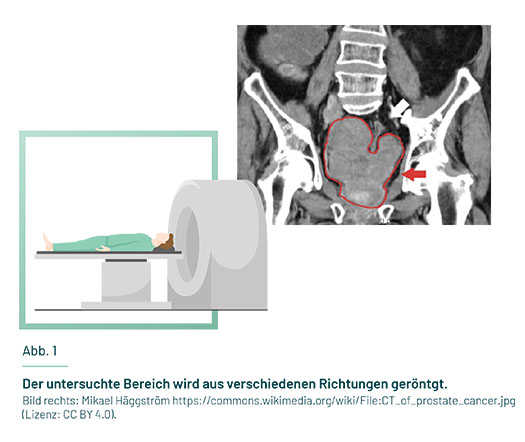 Bildgebung beim metastasierten Prostatakrebs | leben-mit-prostatakrebs.de