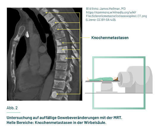 Bildgebung beim metastasierten Prostatakrebs | leben-mit-prostatakrebs.de