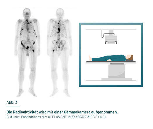 Bildgebung beim metastasierten Prostatakrebs | leben-mit-prostatakrebs.de